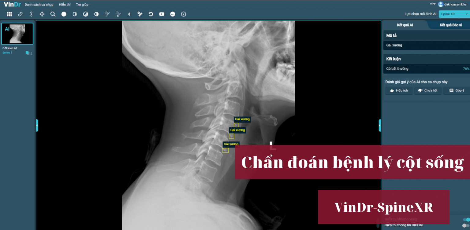 VinDr AI hỗ trợ chẩn đoán sớm nhiều bệnh lý nguy hiểm của người Việt – VinBigdata Product